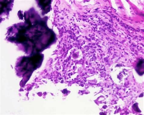 38 Springbok C1 Gastrocnemius Muscle Calcinosis Circumscripta Hande
