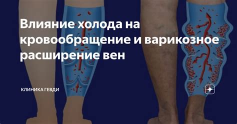 Влияние холода на кровообращение и варикозное расширение вен Клиника