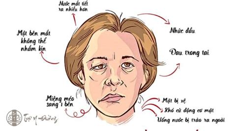 Liệt Dây Thần Kinh 7 Ngoại Biên MÉo MẶt Tuệ Y Đường