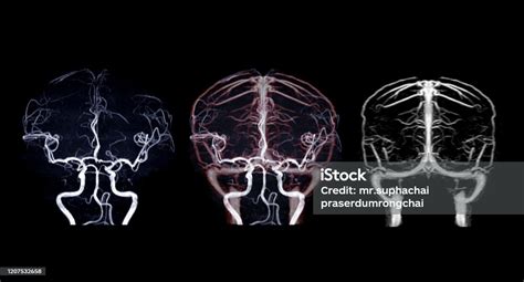 Mra 뇌와 Mrv 뇌 Mri 스캐너에 대한 스톡 사진 및 기타 이미지 Mri 스캐너 Mri 스캔 뇌 Istock
