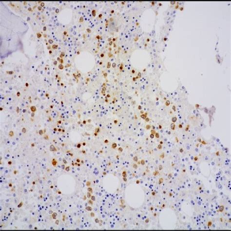 High Power View Showing A Diffuse Proliferation Of Cd56 Positive Download Scientific Diagram