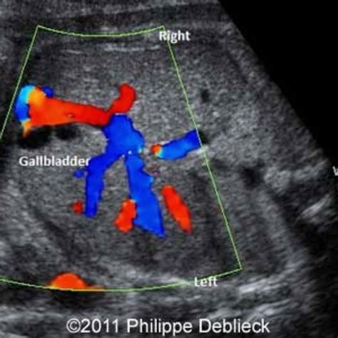 📃 Persistent Right Umbilical Vein