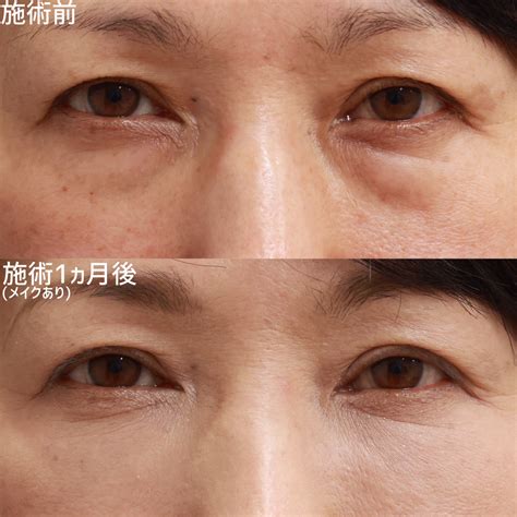 自分ではケアできない目の下のふくらみを改善！｜症例写真・ビフォーアフター｜美容整形･美容外科のtaクリニックグループ