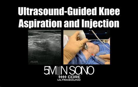 Practical Pocus On Linkedin Knee Aspiration And Injection