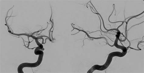 Embolization Of The Right Ica Paraophthalmic Segment Aneurysm With A Flow Diverting Stent
