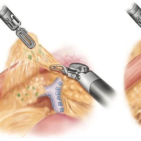 Subcarinal Lymph Node Packet Is Removed En Bloc Extreme Caution Is
