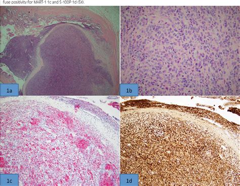 Figure 1 From Metastatic Malignant Melanoma To The Gallbladder Case