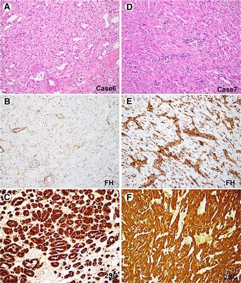 Incidence Of Succinate Dehydrogenase And Fumarate Hydratase Deficient