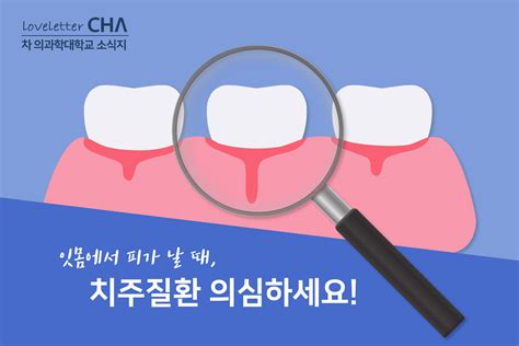 [cha Health] 잇몸에서 피날 때 치주질환 의심하세요 Cha Newsroom