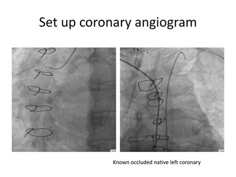 Cto Pci Using Lima As Retrograde Conduit Saqib Ghani Ppt