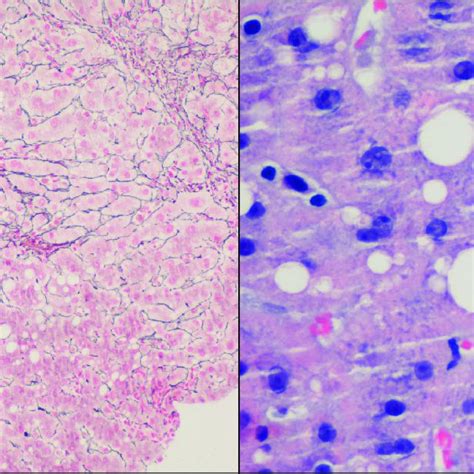Liver Parenchyma With Expanded Portal Triads By Polymorphic