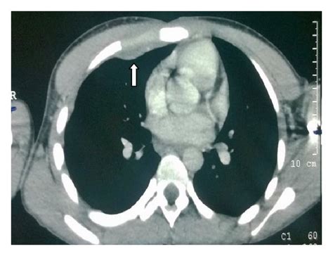 Axial Cect Image At Lesion Level In Mediastinal Window Showing Well