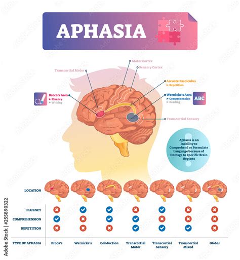 Aphasia Vector Illustration Labeled Educational Scheme With Brain