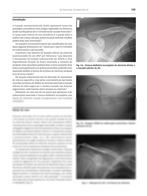 SOLUTION Luxa O Acromioclavicular Tipo Vi Associada Fratura Diafis Ria