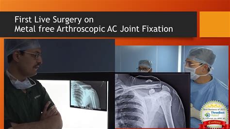 Ac Joint Dislocation First Ever Live Metal Free Arthroscopic Fixation