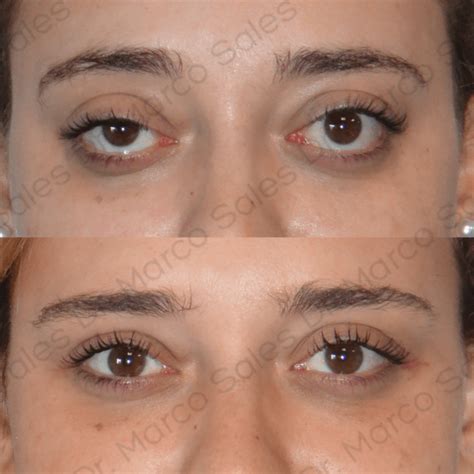 Orbitopatía Tiroidea Dr Marco Sales