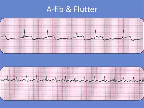 Basics Of Ecg Pdf