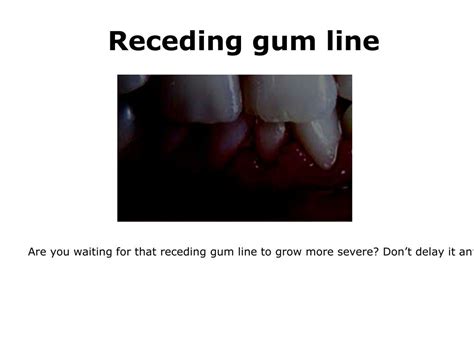 Ppt Receding Gums Cure Powerpoint Presentation Free Download Id