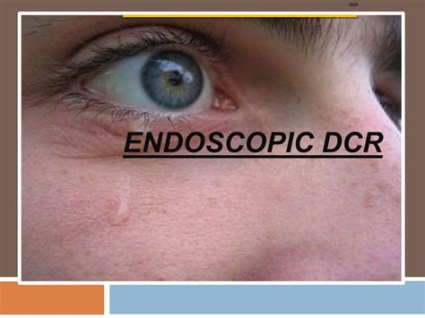 Endoscopic Dcr Ppt