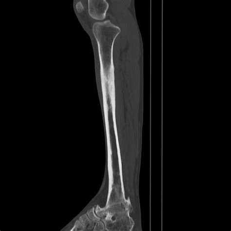 Brodie Abscess Tibia Radiopaedia 66028 75204 Sagittal Bone Window