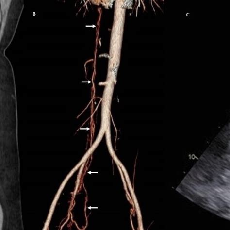 A Ct Filling Defect On Lower Vena Cava And Mass On Uterus B Ct