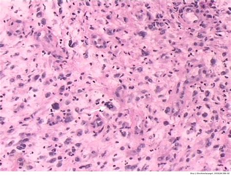 Undifferentiated High Grade Pleomorphic Sarcoma Of Ethmoid Sinus A Case Report And Literature