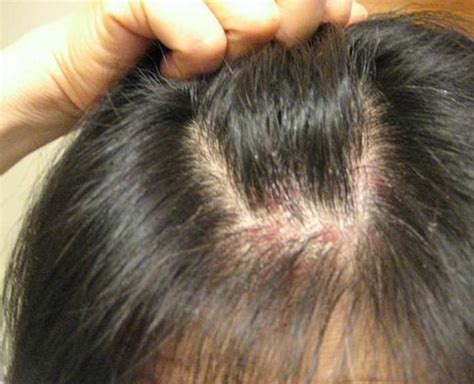 How To Cure Scalp Pimples Due To Dandruff How To Cure Pimples Due To