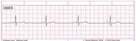 Ecg Simple Flashcards Quizlet