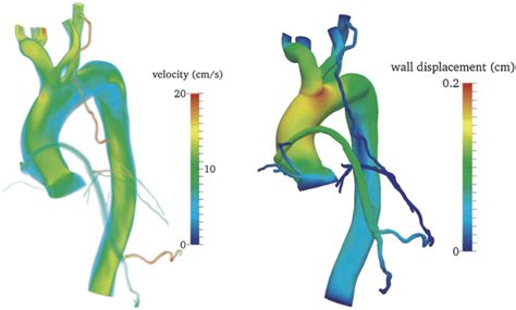 Simvascular An Open Source Pipeline For Cardiovascular Simulation Springerlink