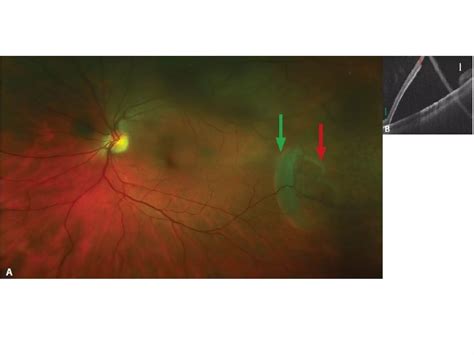 Retinoschisis Ppt