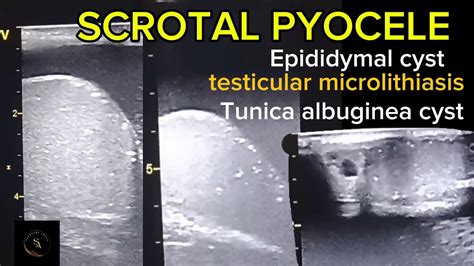 Complex Hydrocelescrotal Pyocele Epididymal Cyst Testicular