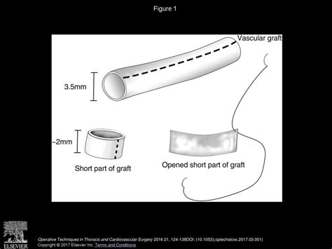 Growing The Borderline Hypoplastic Left Ventricle Hybrid Approach