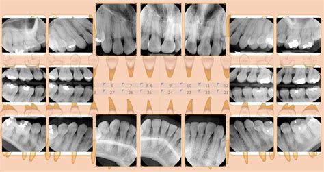 Why Should I Have Dental X Rays Taken