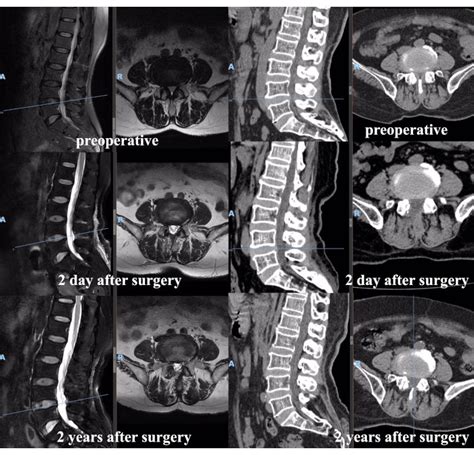 Percutaneous Endoscopic Unilateral Approach Bilateral Decompression For
