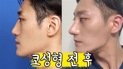 태구 Vlog 남자코 수술 레전드 매부리코 싹 사라짐 코 성형하고 여친생김 ☺ Youtube