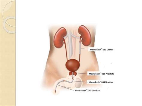 Management Of Anterior Urethral Stricture By Aua 2014 Ppt