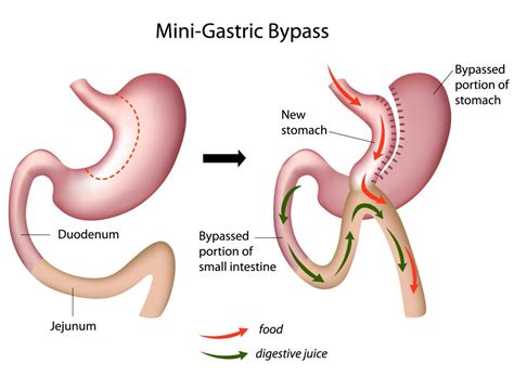 Laparoscopic One Anastomosis Gastric Bypass Oagbmgb Gbmc Jordan