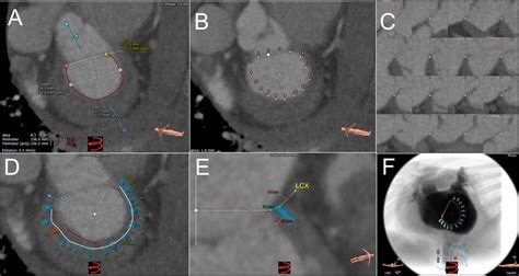 Pre Procedural Cardiac Computed Tomography Virtual Anchor Planning For