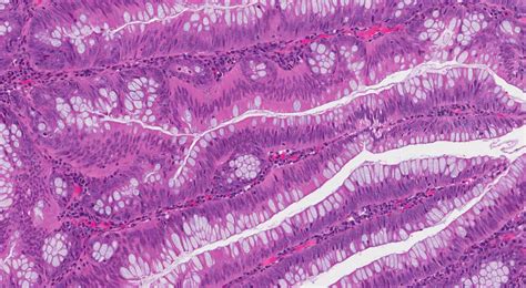 Tlaleho Ea Hau Ea Pathology Bakeng Sa Serrated Adenoma Ea Setso