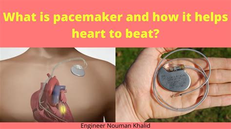 How Does A Pacemaker Defibrillator Work At Angela Rich Blog