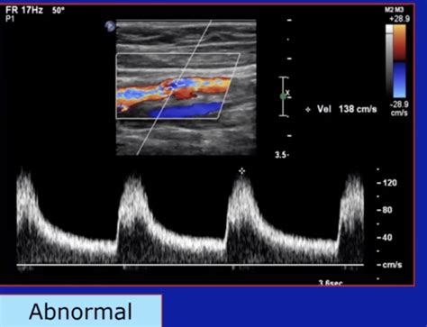 Spectral Doppler Waveforms Flashcards Quizlet