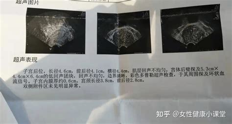 得了子宫肌瘤怎么办尤其是正在备孕中的女性看看这个真实案例 知乎