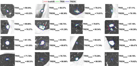 Segmentation Examples For The Lidc Nodules Generated Using The Proposed Download Scientific