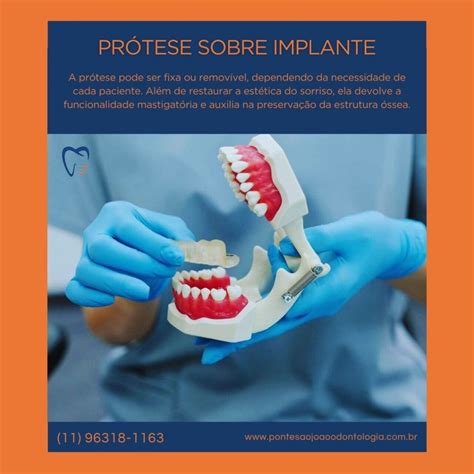 Prótese Sobre Implante Quais São Os Principais Tipos E Suas