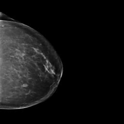 Breast Tumor Detection Object Detection Dataset By BrCancerYOLOv