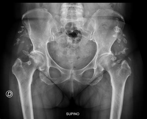 Hip Injection X Ray At Pearl Jenks Blog