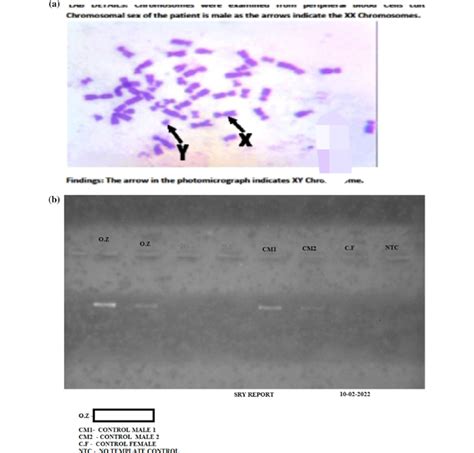 A The Arrow In The Photomicrograph Indicates Xy Chromosomes B