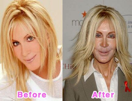 Celebrity Plastic Surgery Disasters Before And After Celebrity