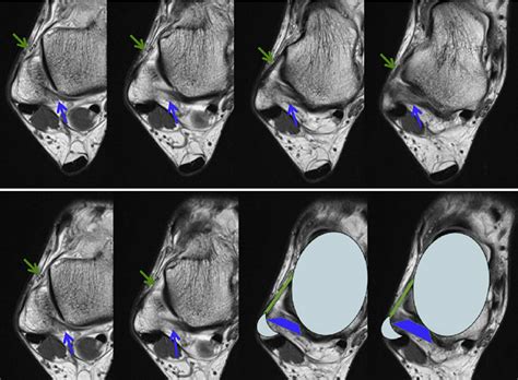 Normal Talofibular Ligaments Consecutive Pd Axial Images At The Level