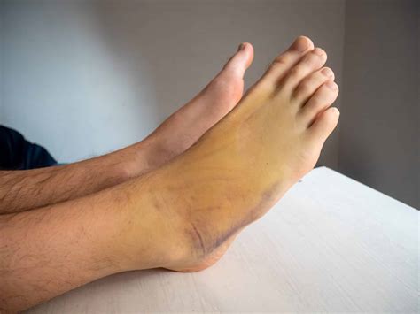 Contusion Guide Bruise Muscle And Bone Contusions